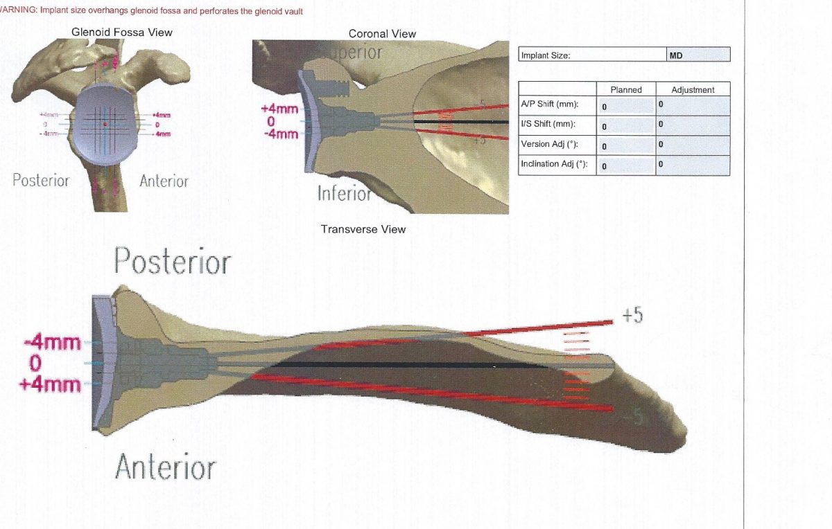 New Tech Improves Shoulder Replacements | Colorado Sports Doctor