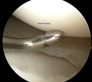 What is Chondromalacia? - Dr. Chris Jones Colorado Springs, CO