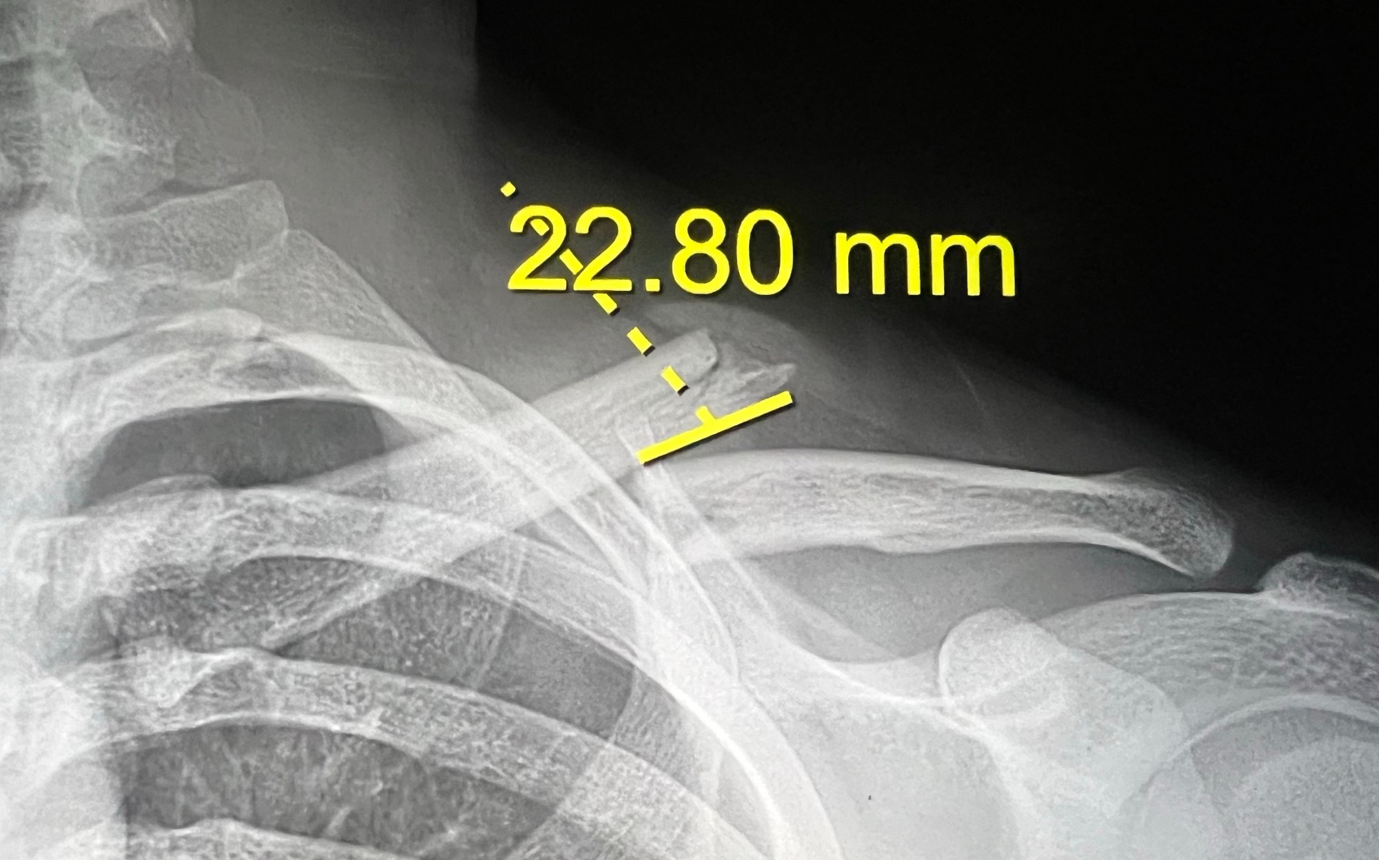 Mountain Bike Accident - What To Know About Clavicle Fractures