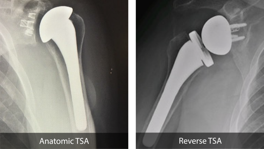 Reverse Shoulder Replacement - Dr. Chris Jones Colorado Springs, CO